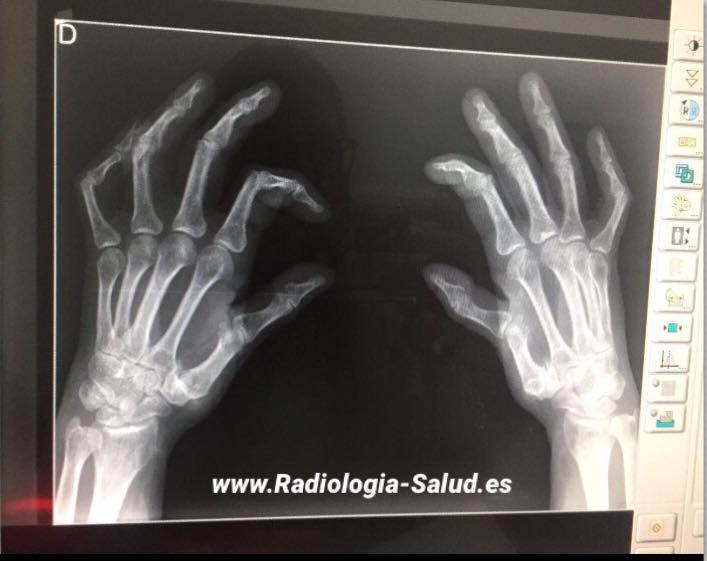 Radiología e Imagen para el Diagnóstico: Casos en Radiología: Dedo ...